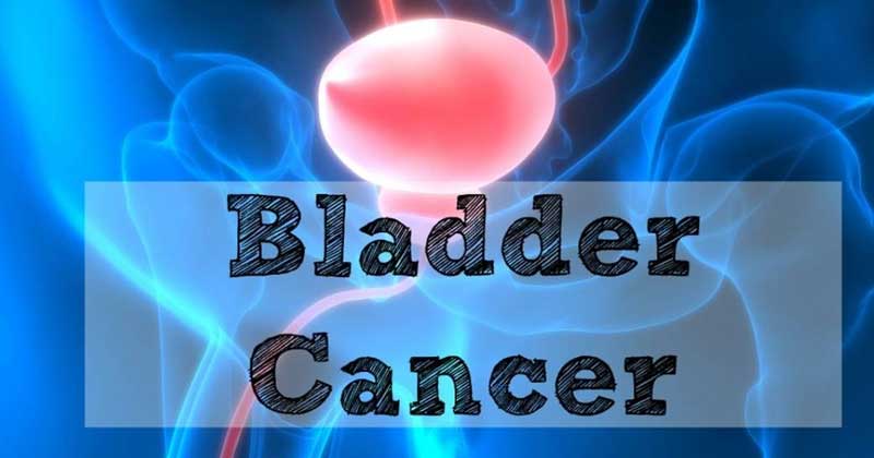 Managing a Case of Urinary Bladder Cancer