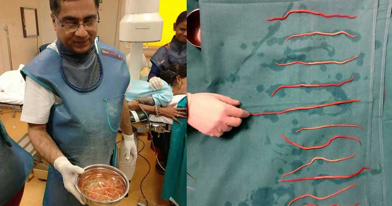 Surgeons Removed 14 Huge Wriggling Worms From A Woman’s Organ