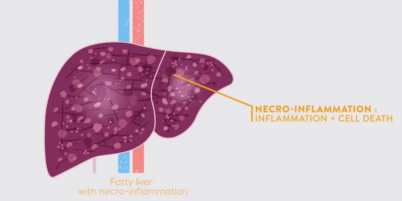 What Causes Liver Damage and The Symptoms of Liver Damage?