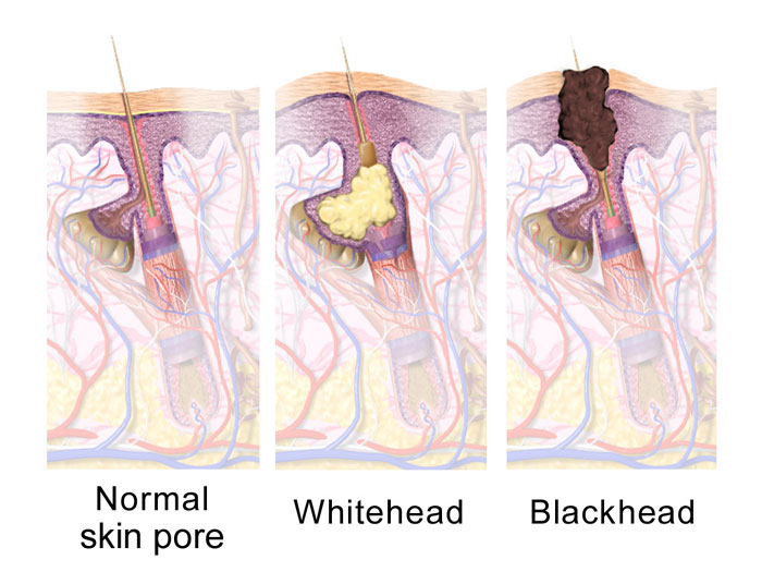 How To Prevent Blackheads From Forming And How To Deal With Them?