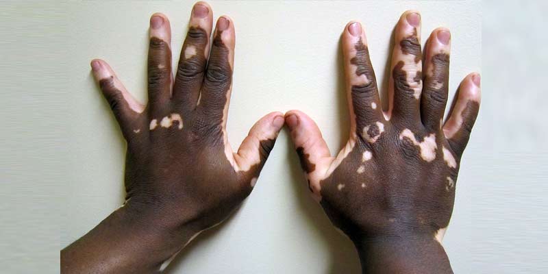 Vitiligo: Causes & Treatments | What Triggers Vitiligo?