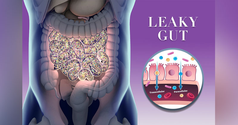 Time To Repair And Replenish The Barrier: Leaky Gut Syndrome